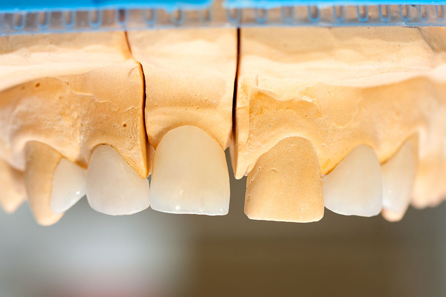 5). E-Max Crowns